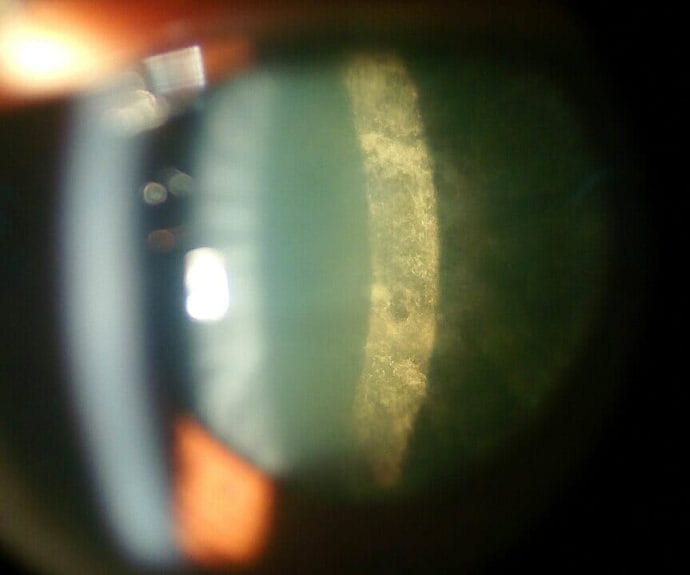 Cataract Stages Explained for Better Eye Health