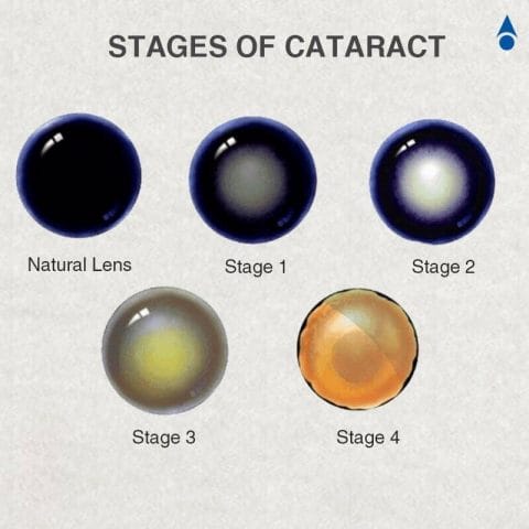 Cataract Stages Explained for Better Eye Health