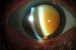Cataract Stages Explained for Better Eye Health
