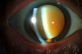 Cataract Stages Explained for Better Eye Health