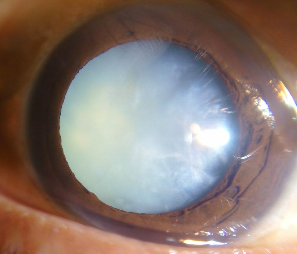Cataract Stages Explained for Better Eye Health