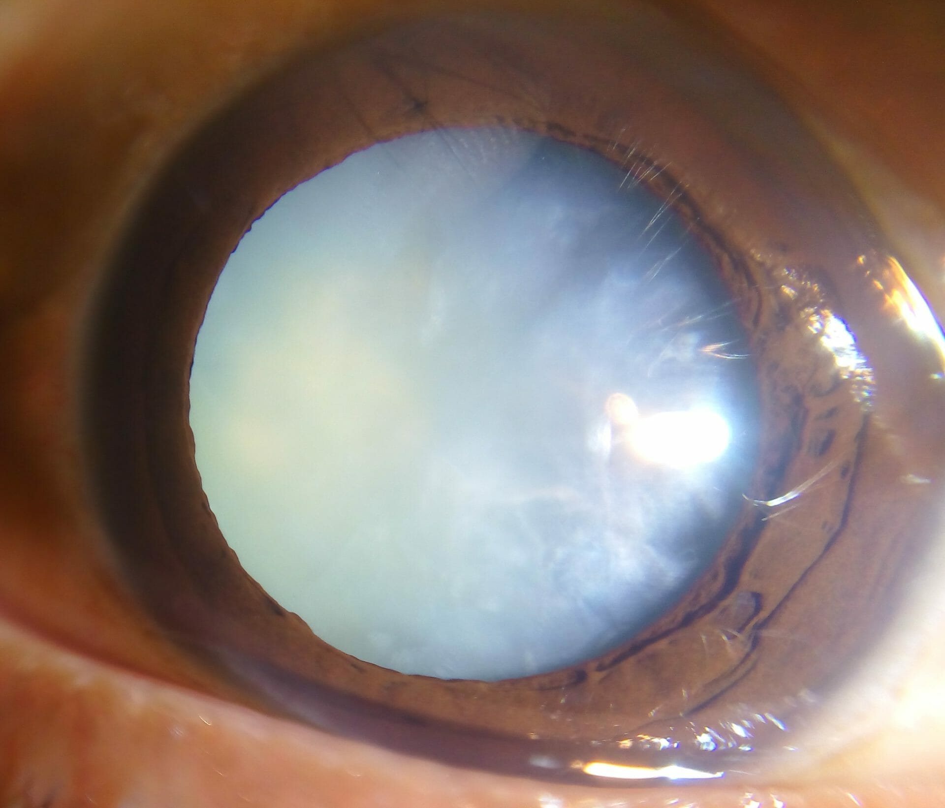 Cataract Stages Explained for Better Eye Health