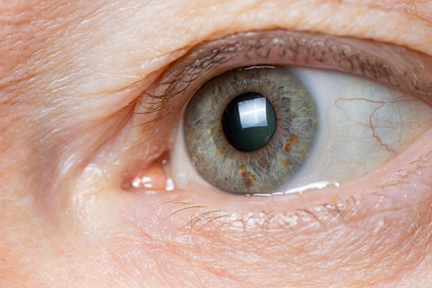 Cataract Stages Explained for Better Eye Health