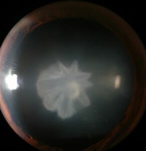 Cataract Stages Explained for Better Eye Health