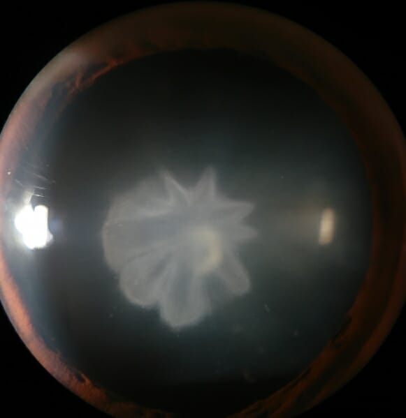 Cataract Stages Explained for Better Eye Health